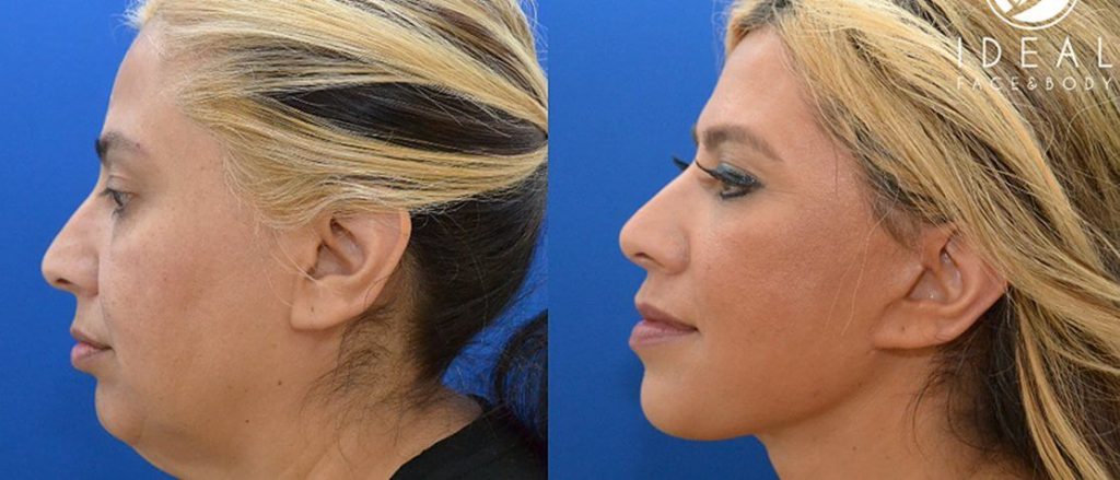 Facelift Beverly Hills - Ideal Face & Body