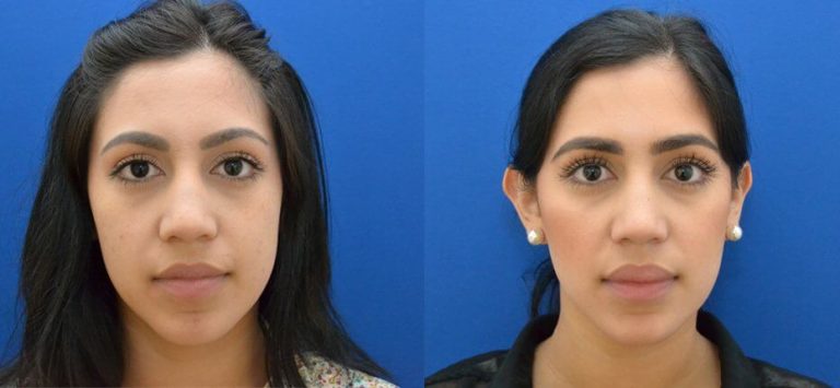 Buccal Lipectomy | Cheek Reduction | Ideal Face and Body