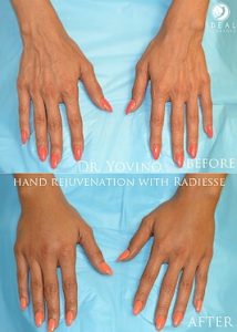 Hand Rejuvenation Beverly Hills - Ideal Face & Body